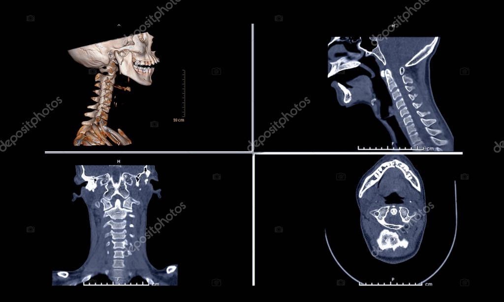 Comparación de la imagen de TC de columna C o columna cervical 3D ...