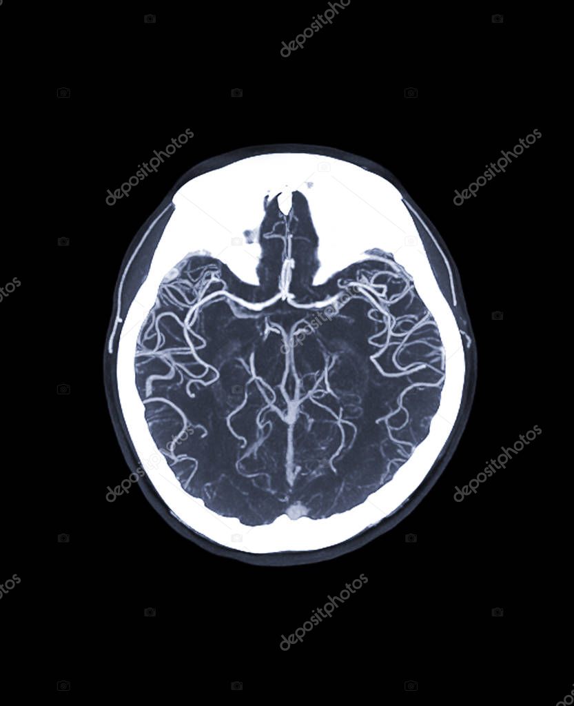 CTA angiografía cerebral o TC del cerebro Vista mip axial. concepto de ...