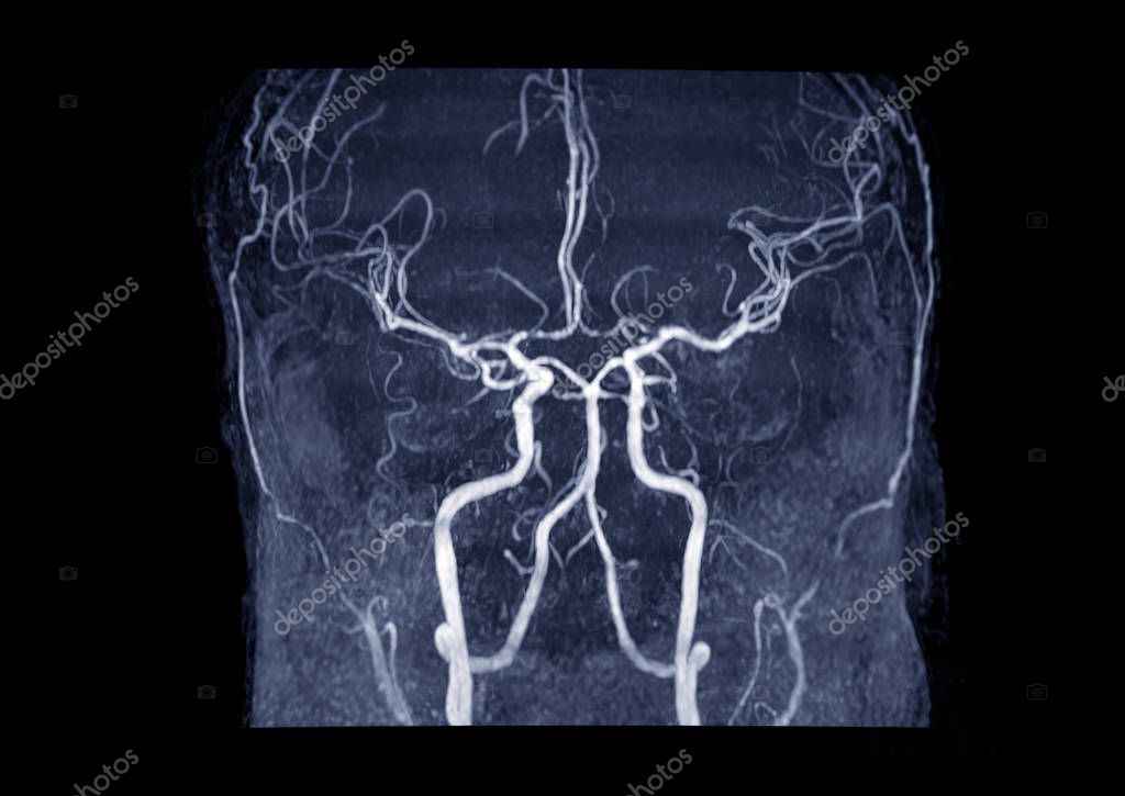 ARM Angiografía cerebral o por resonancia magnética (ARM) de la arteria ...