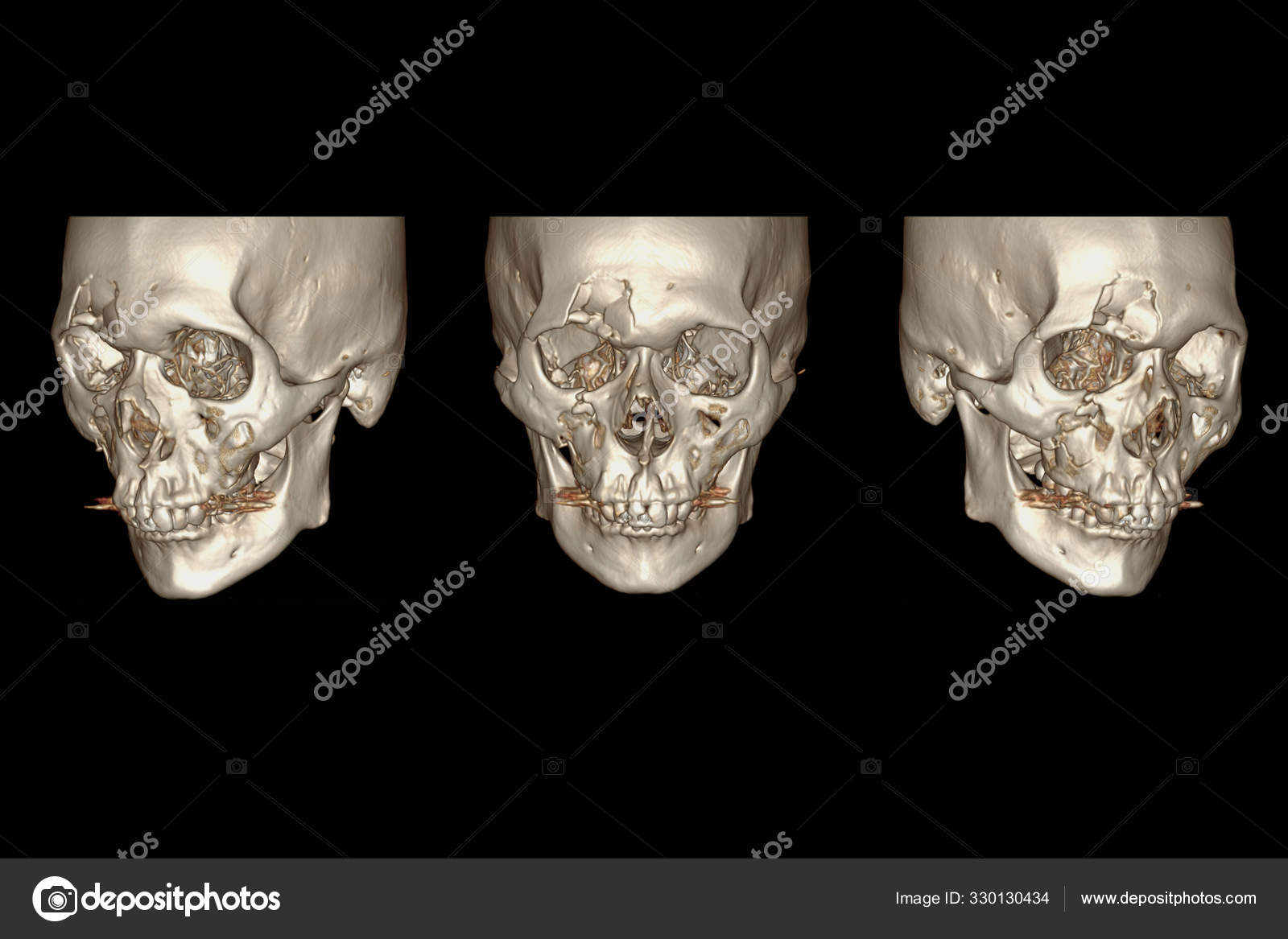 Facial Bone Rendering Image Isolated Black Background Showing Fracture ...
