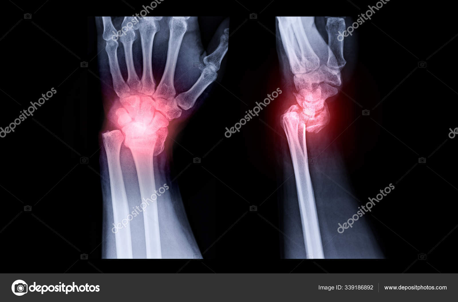 X Ray Wrist Lateral View