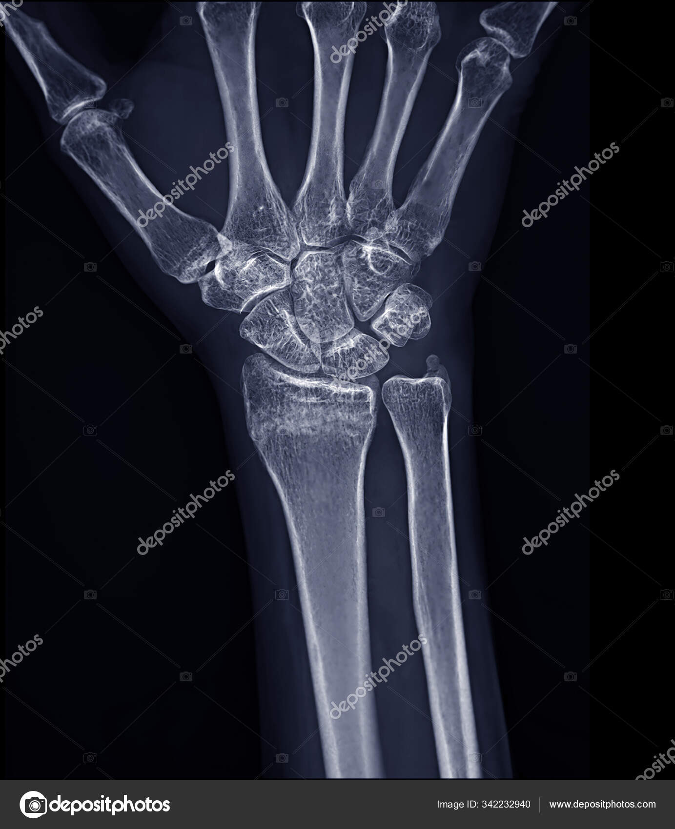 Visao Lateral Do Pulso De Raio X