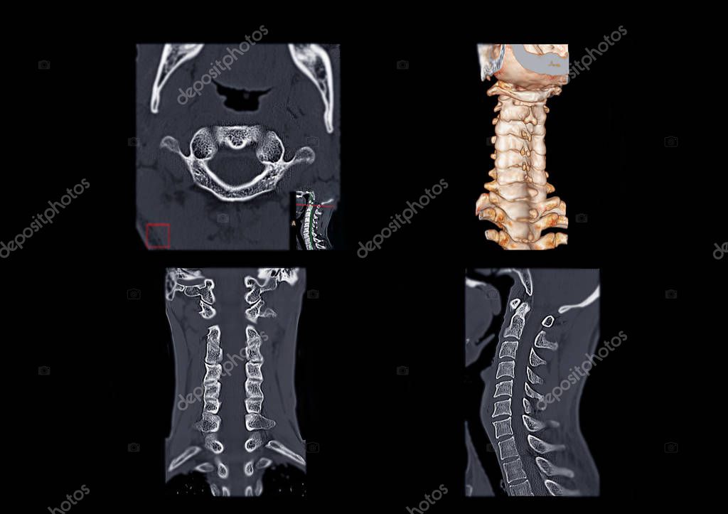 Tomografía computarizada C-columna vertebral o vista axial cervical ...