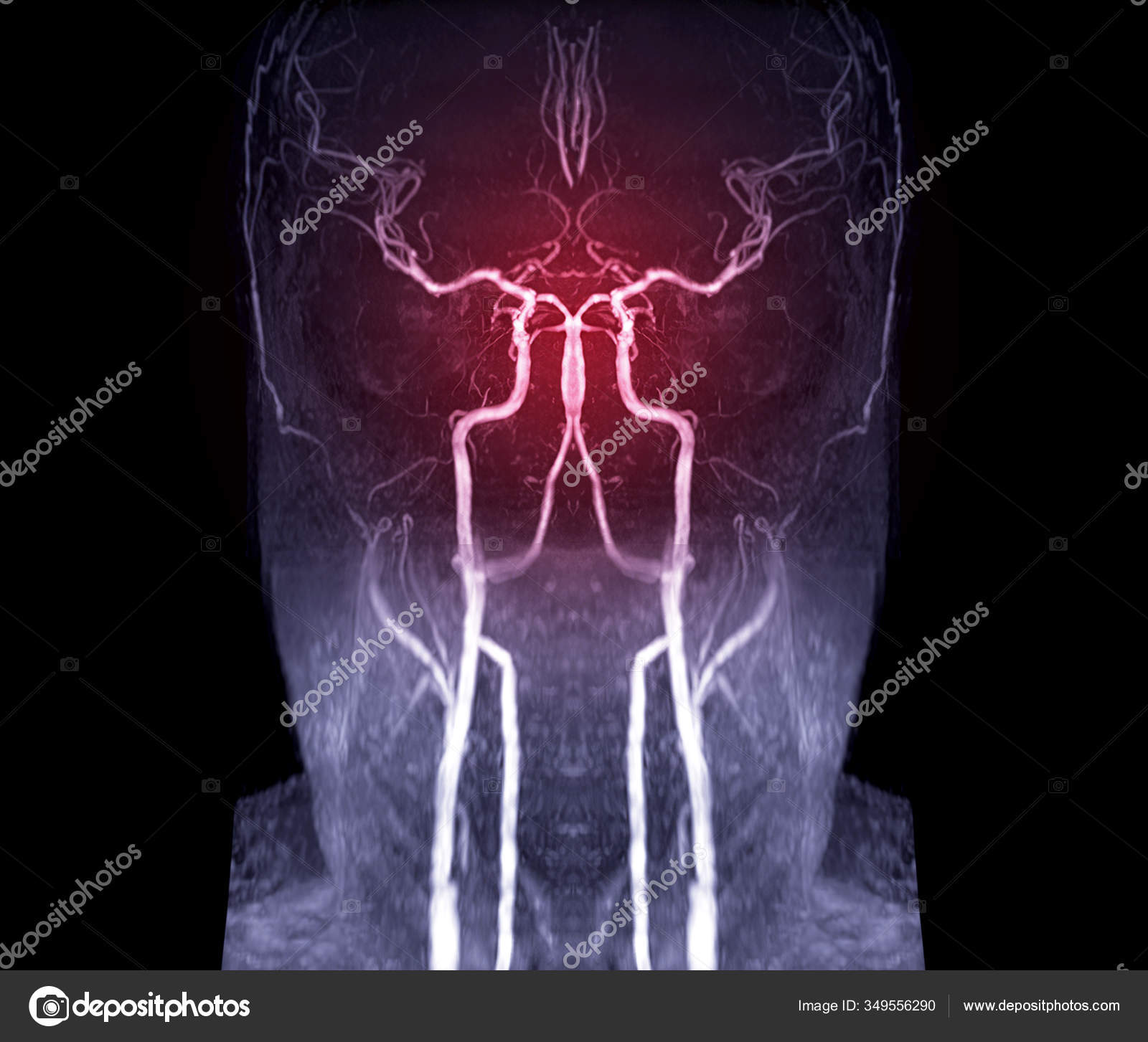 Mra Brain Magnetic Resonance Angiography Mra Cerebral Artery Evaluate ... Mra Brain Magnetic Resonance Angiography Mra Cerebral Artery Evaluate ...