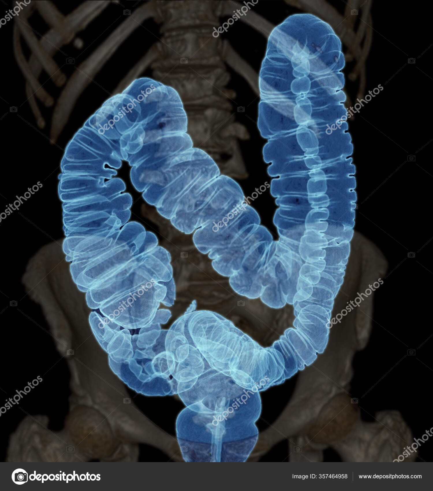 Colonography Scan Colon Rendering Image View Showing Colon Screening ...