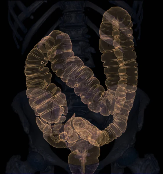 Colonography Scan Colon Rendering Image View Showing Colon Screening ...