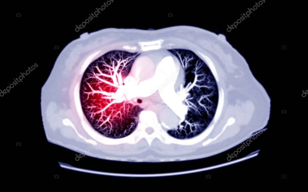 Enfoque selectivo de la TC torácica AXIAL MIP view for diagnostic ...