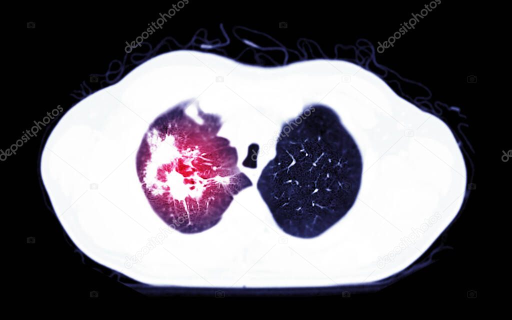 Enfoque selectivo de la TC torácica AXIAL MIP view for diagnostic ...