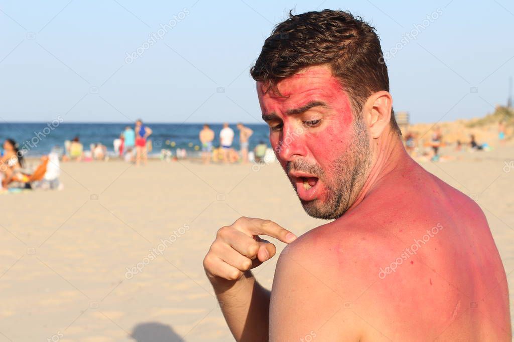 Hombre recibiendo sol quemado en la playa 2024