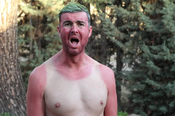 Quemada por el sol fotos de stock, imágenes de Quemada por el sol sin ...