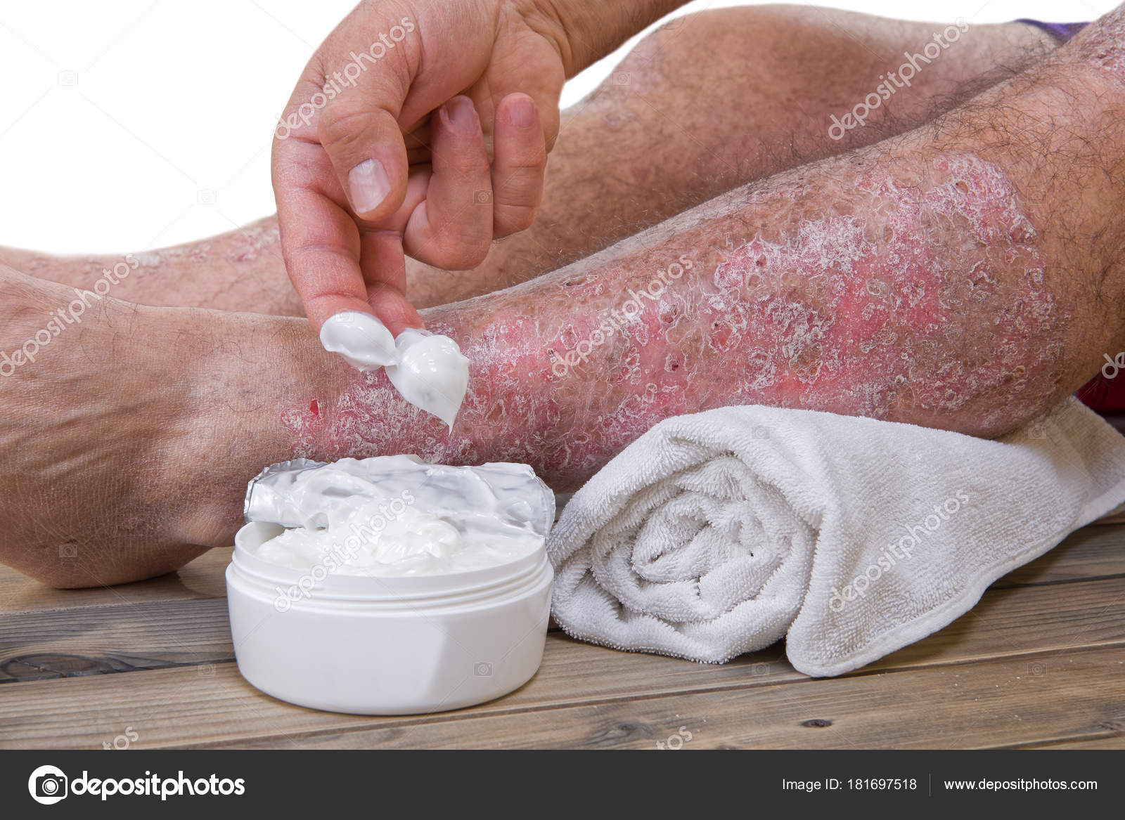 Psoriasis skin lesions Stock Photo by ©osmar01 181697518