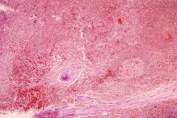 Epidermoid carcinomas Stock Photos, Royalty Free Epidermoid carcinomas ...