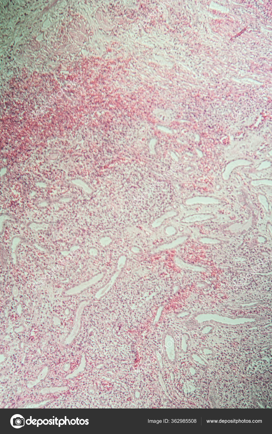 Poly Nephritis Tissue Microscope 100X — Stock Photo © dr.lange.unitybox ...