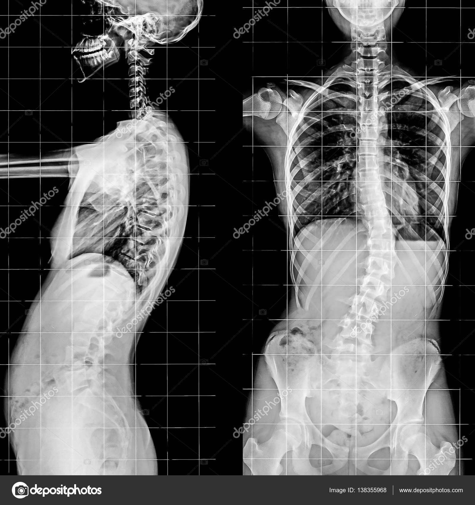 Raio X Da Coluna - vrogue.co