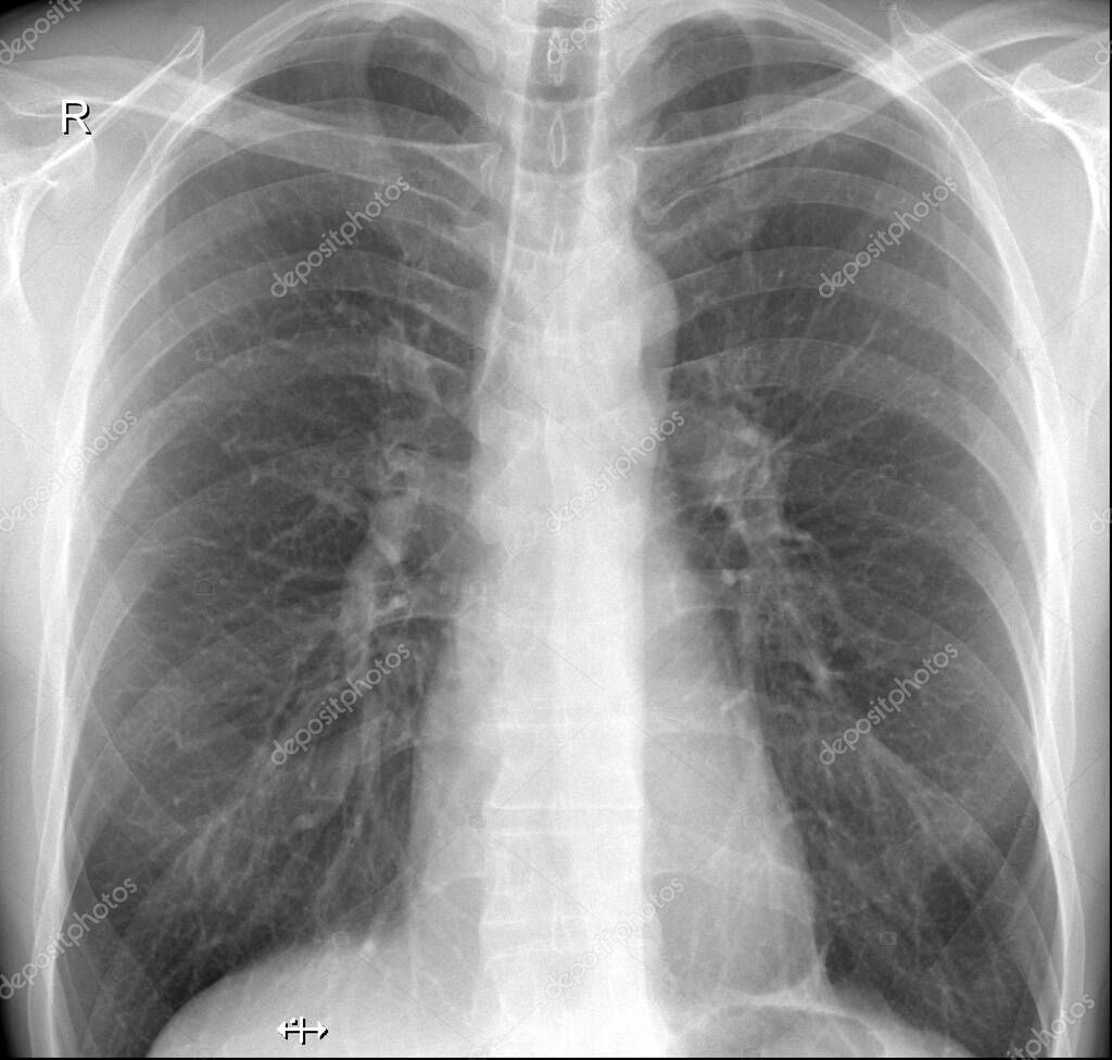 Radiografía de los pulmones y el pecho de una persona sana. En la ...