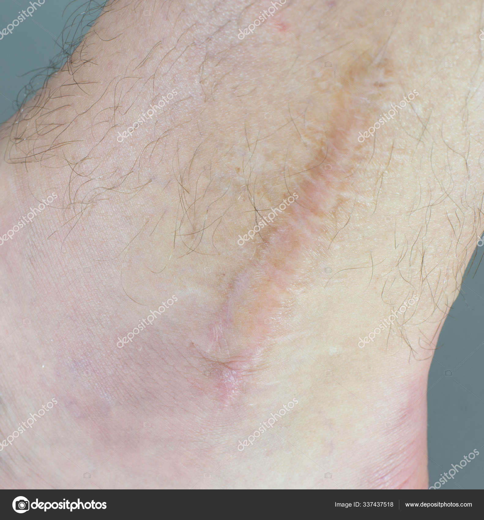 Medical Stitches On Leg