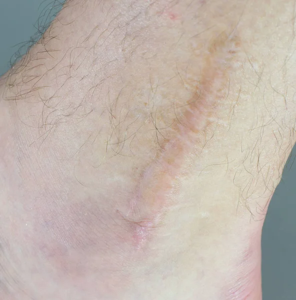 Old scar Stock Photos, Royalty Free Old scar Images | Depositphotos