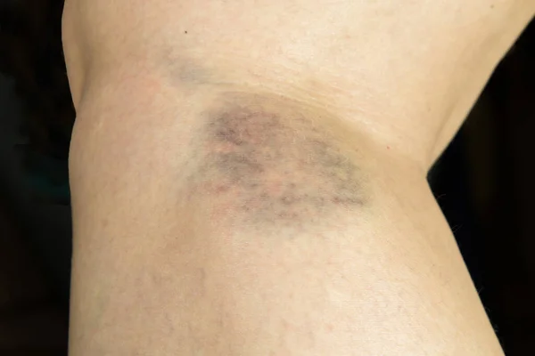 Bruise in the arm Stock Photo by ©cunaplus 143993811