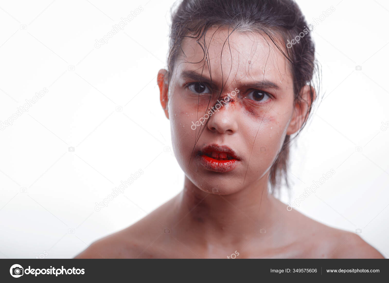 Young Woman Bruises Face Victim Domestic Violence Female Fighter ...