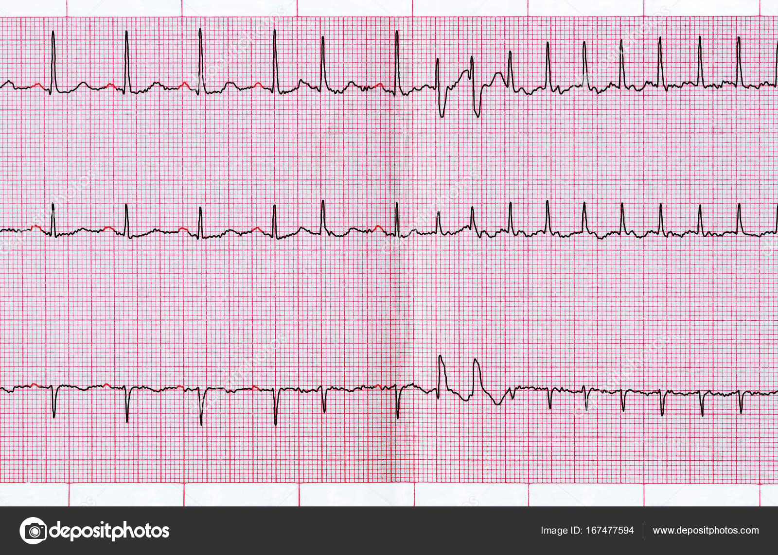 ECG with supraventricular extrasystole and short paroxysm of atrial ...