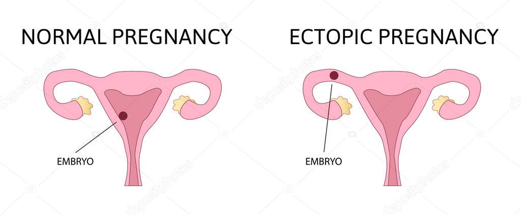 Embarazo ectópico y normal. El óvulo fertilizado, útero, útero. La ...