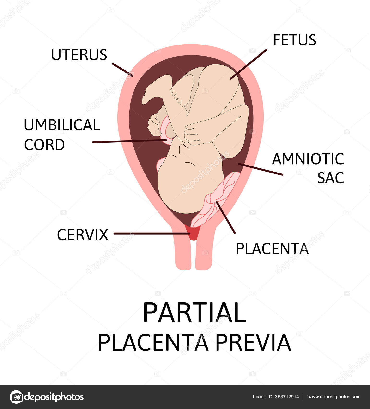 Different Placental Locations During Pregnancy. Major and Normal ...