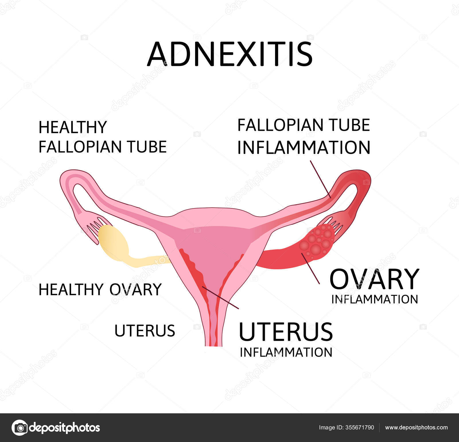 Diagrama Da Cavidade Uterina Resumenes De Ginecologia | Ginecología