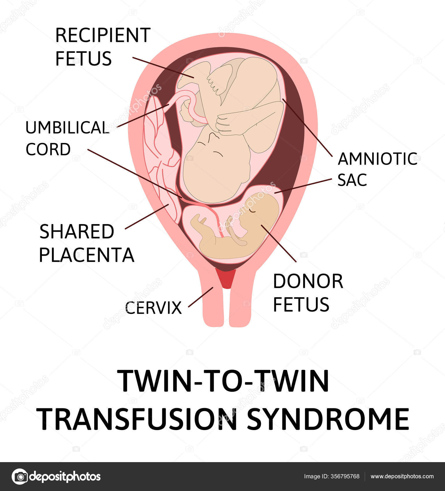 Twin Twin Transfusion Syndrome Feto Fetal Transfusion 60 Off