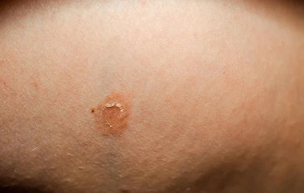 Woman skin cancer Stock Photos, Royalty Free Woman skin cancer Images ...