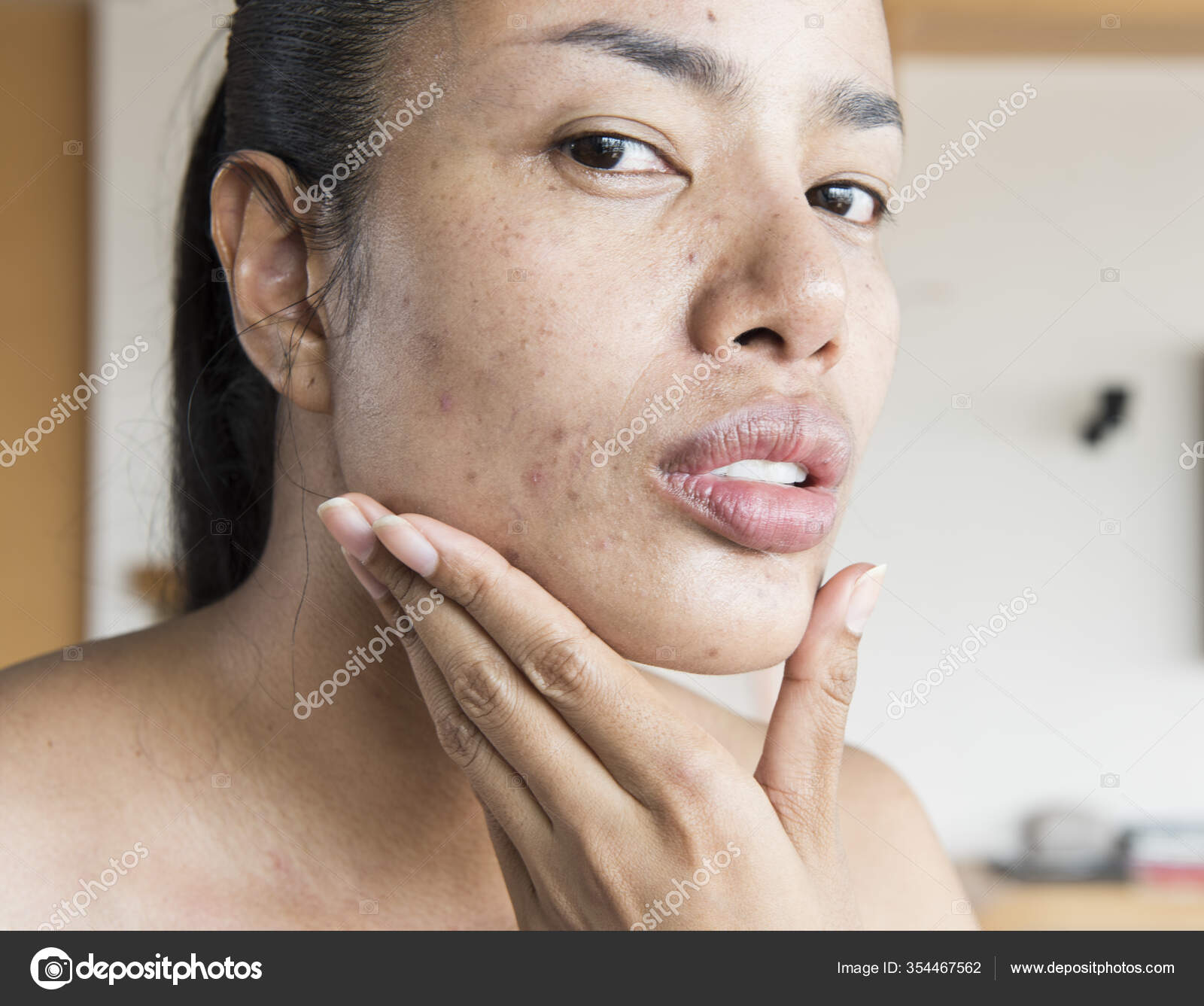 Women Who Have Problems Dry Skin Turn Flaky Skin Very — Stock Photo ...