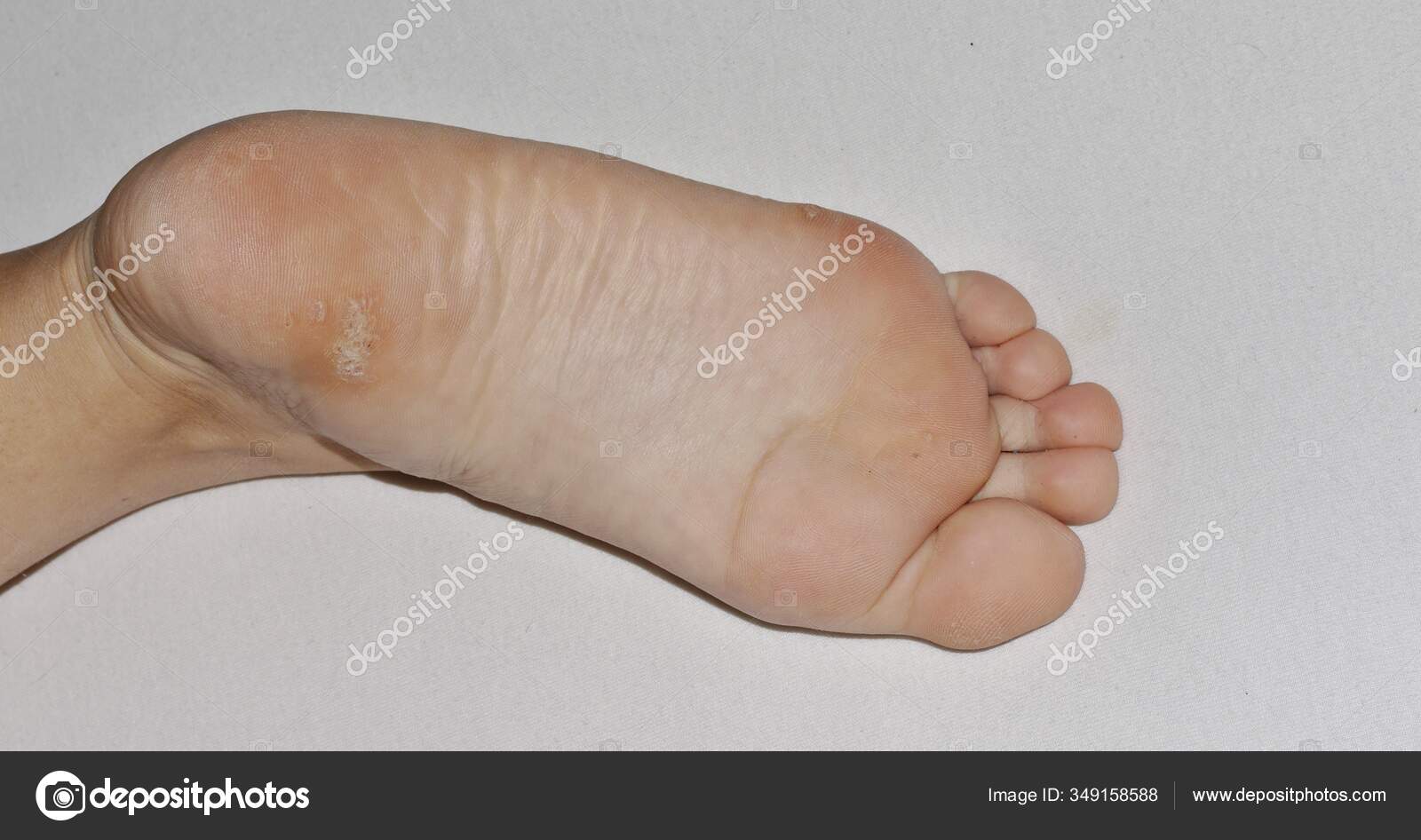 Close Shot Plantar Wart Bottom Foot Heel Caused Human Papillomavirus ...