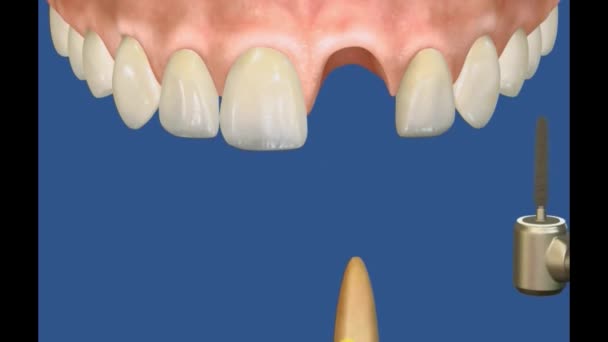 3,015 Dental crown Videos, Royalty-free Stock Dental crown Footage ...