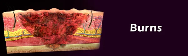 Burn scar Stock Photos, Royalty Free Burn scar Images | Depositphotos