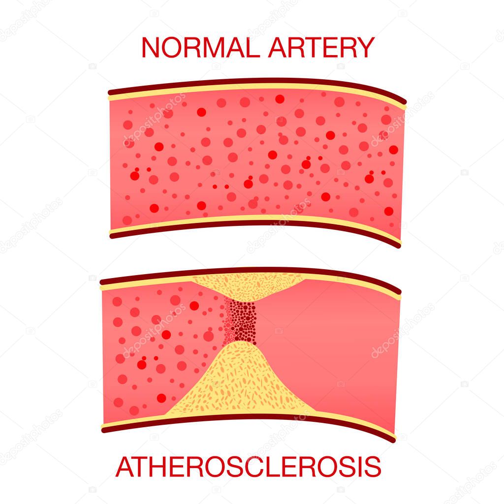 Aterosclerosis.La acumulación de colesterol en los vasos sanguíneos 2023