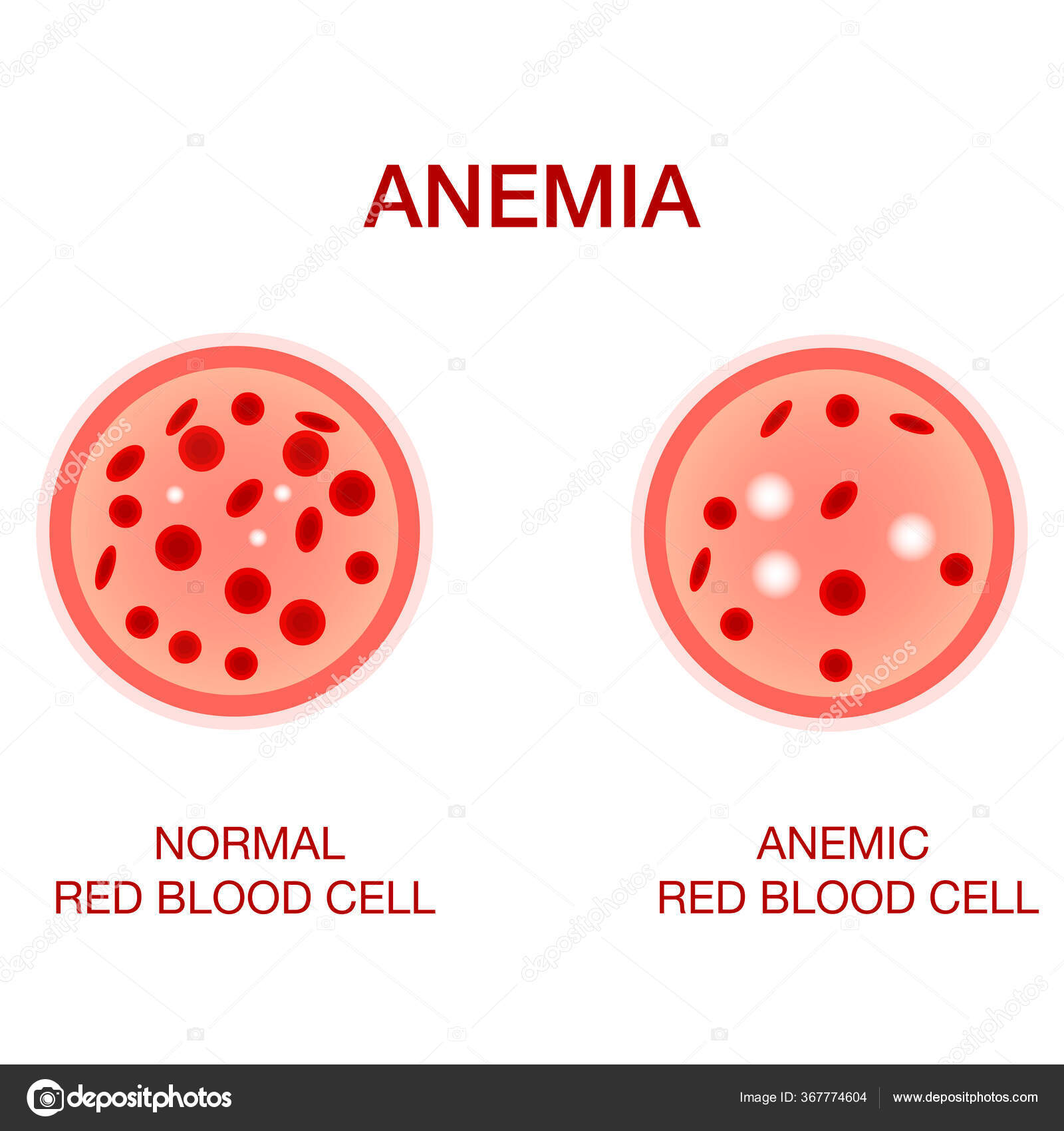 Infographic image of anemia .The difference of Anemia amount of red ...