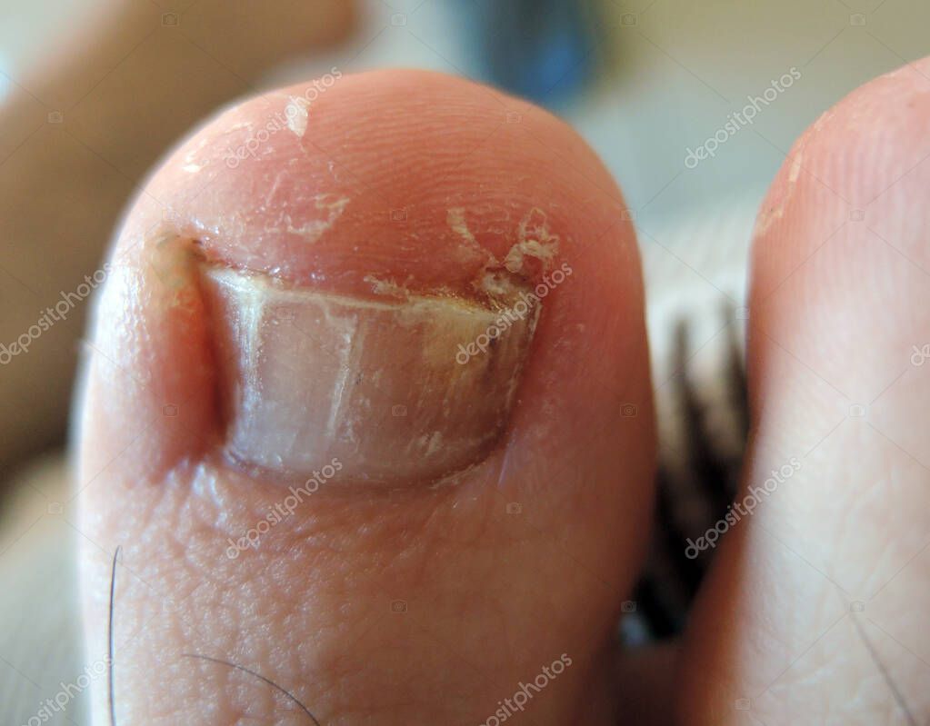 La onicomicosis, también conocida como tinea unguium, es una infección ...