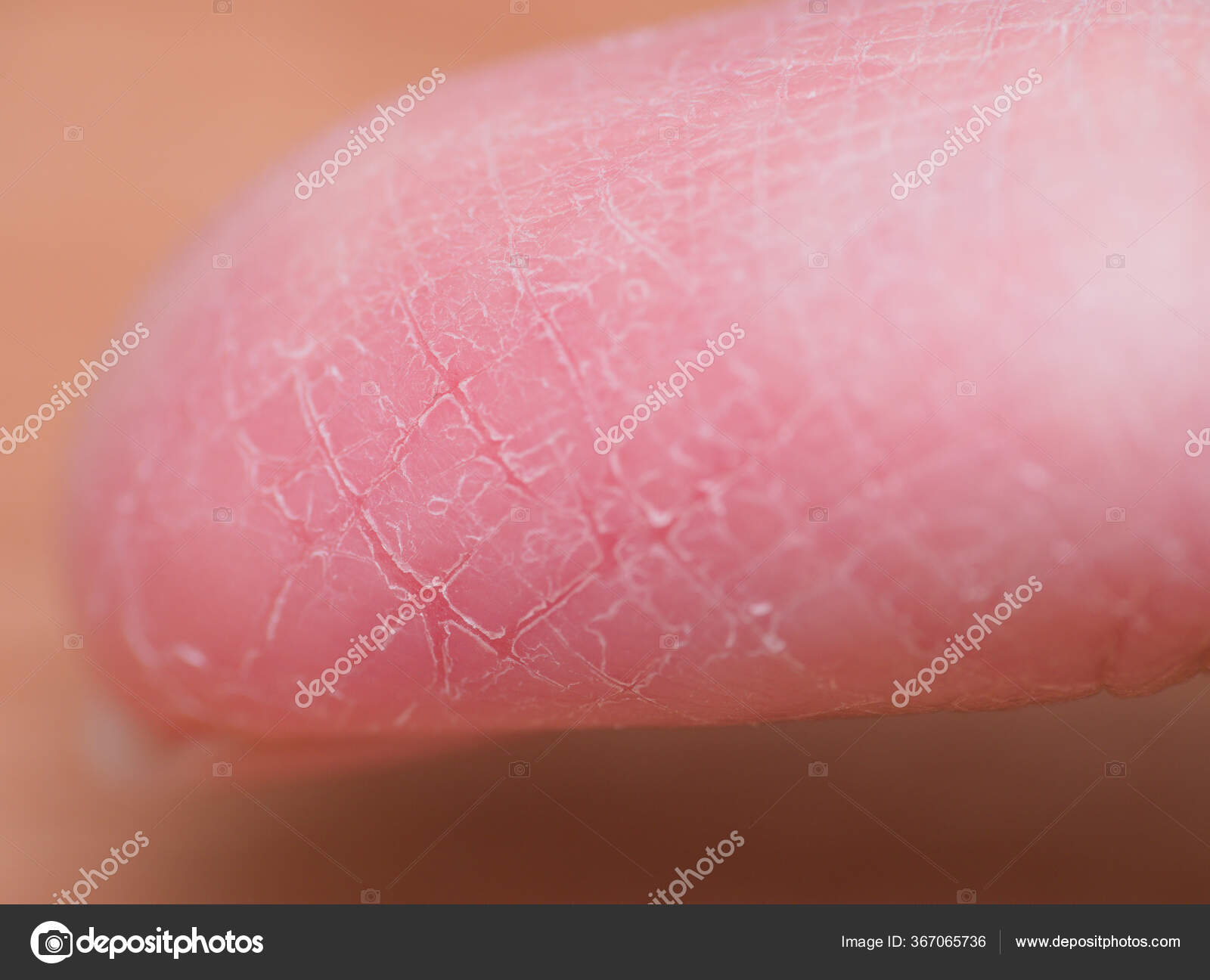 Painful Broken Finger Skin Winter Taking Good Skincare Macro View ...