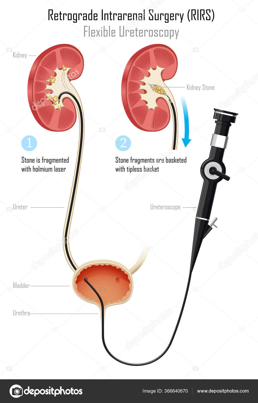Ureteroscopy Urs Youtube