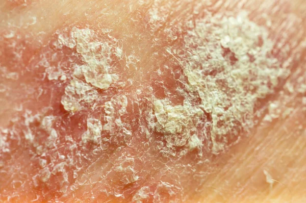 Skin psoriasis Stock Photos, Royalty Free Skin psoriasis Images ...