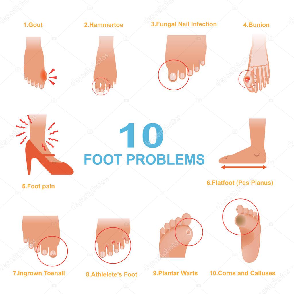 Problemas en los pies Ilustración vectorial 2024