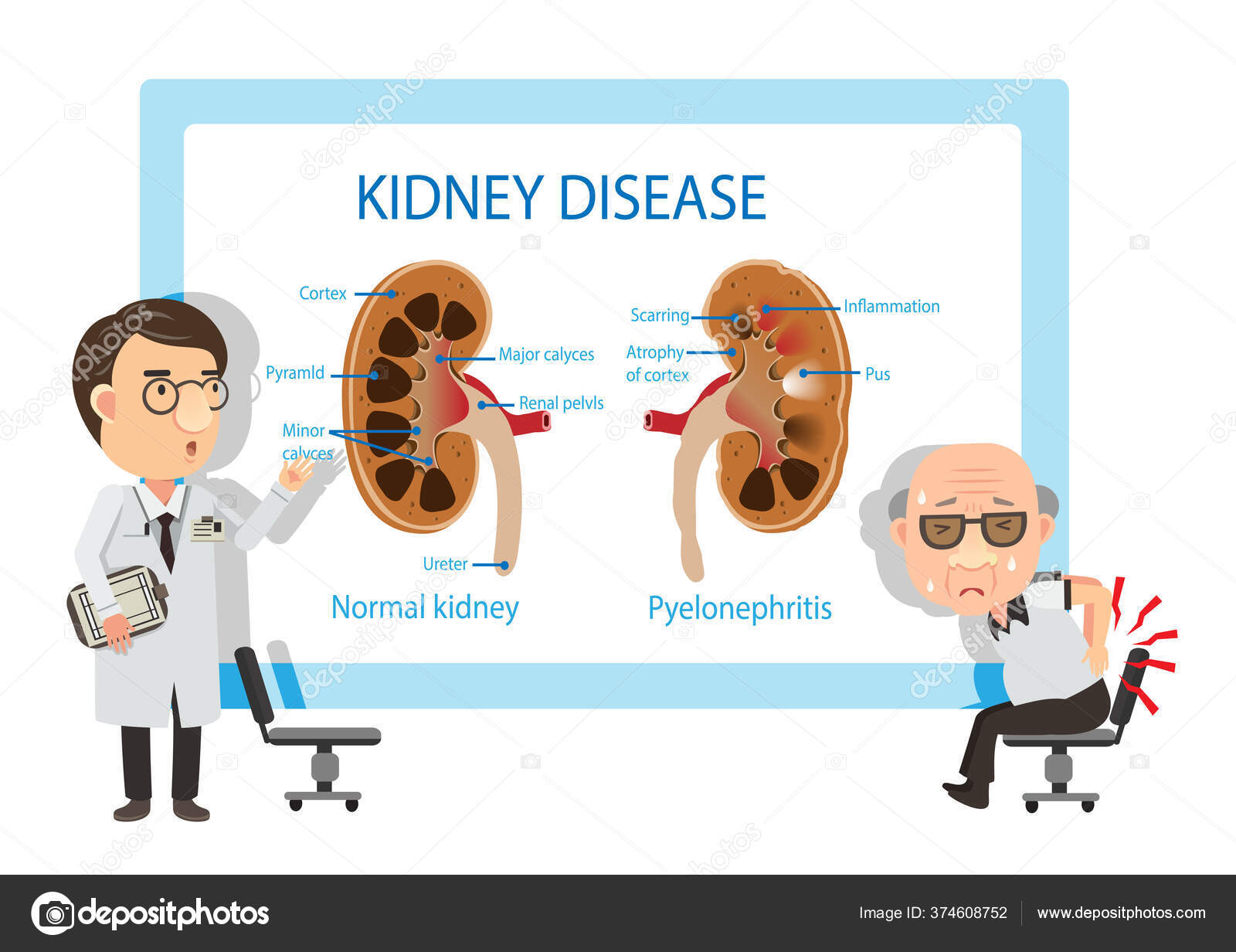 Pyelonephritis Set Vector Illustration Stock Vector Image by ©ann131313 ...