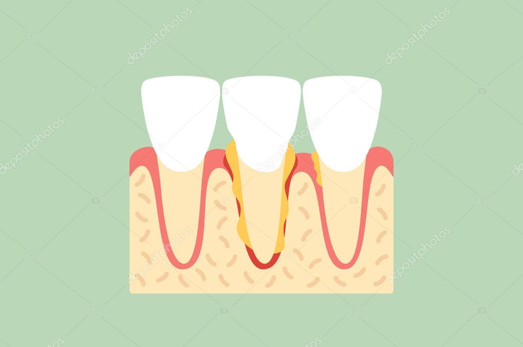 enfermedad periodontal o gingivitis del diente incisivo 2022