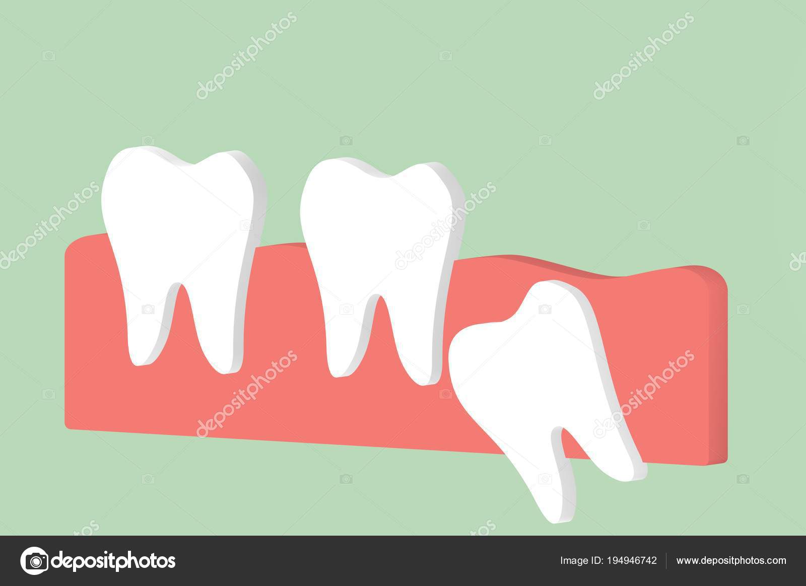 Wisdom tooth ( angular or mesial impaction ) affect to other teeth ...