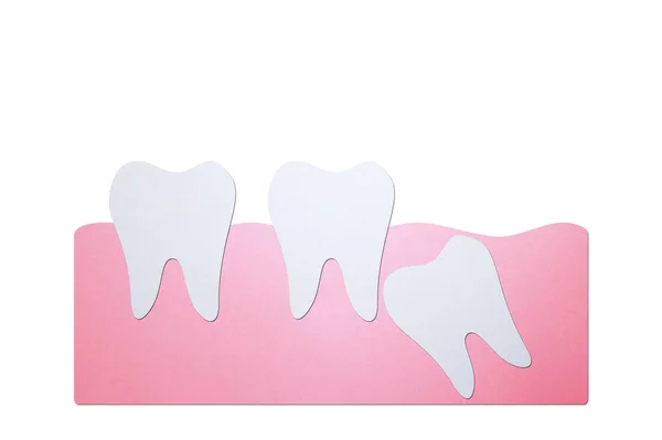 Wisdom Tooth Angular Mesial Impaction Inflammation Affect Other Teeth ...