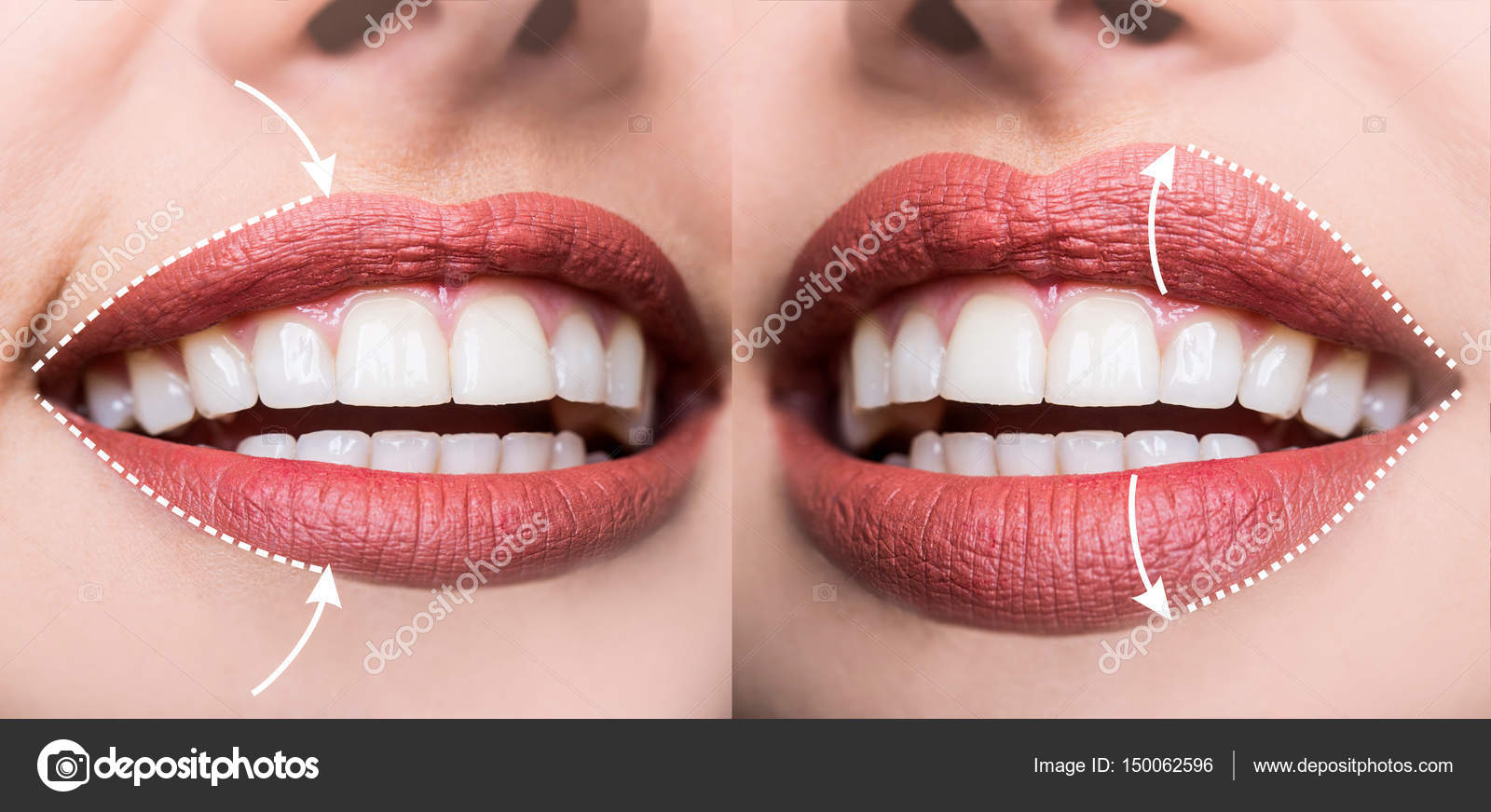 Contour plastic, augmentation of the lips, filling wrinkles, changing ...