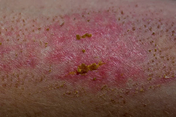 Skin ailment or disease closeup. Wound on the skin heals, crusts. Human ...
