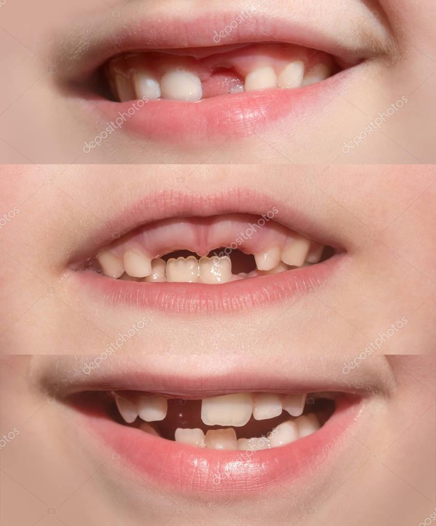 Conjunto de bocas de niños con dientes faltantes. Dientes infantiles ...