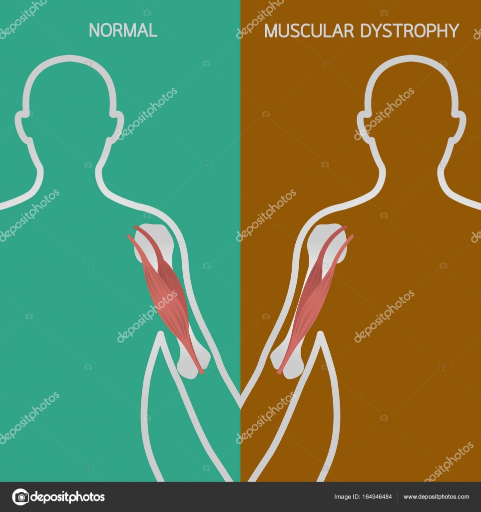 Muscular dystrophy vector illustration Stock Vector by ...