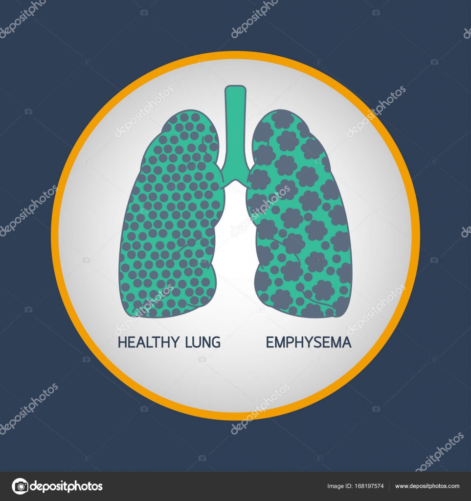 EMPHYSEMA vector logo icon illustration Stock Vector Image by ...