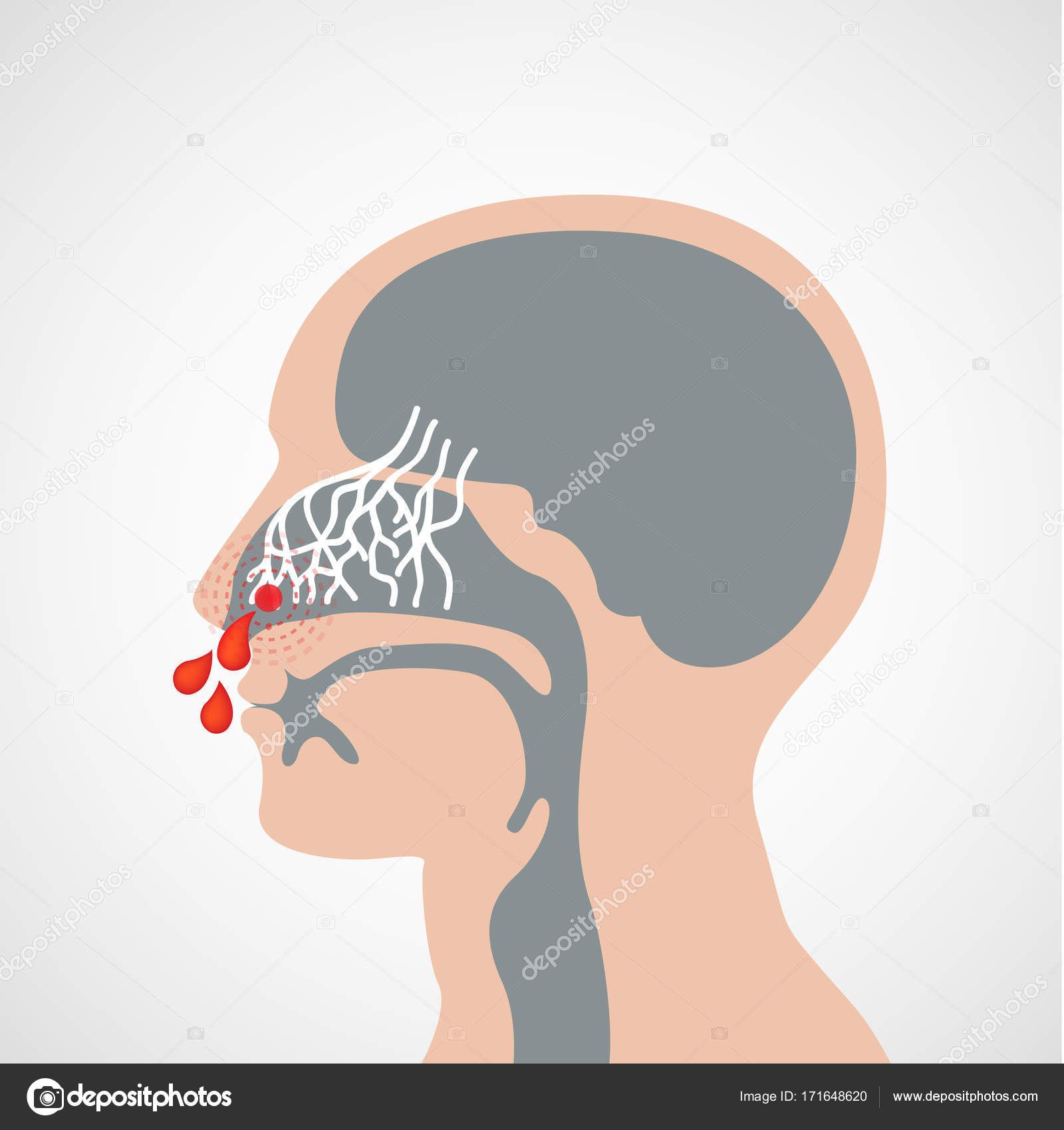 Epistaxis vector logotipo icono ilustración Vector de Stock de ...